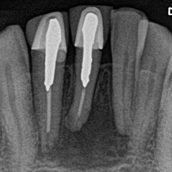 Root Canal Treatment, Endodontist | LEE'S DENTAL CLINIC Tokyo ...